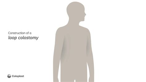 Anatomy Of Loop Colostomy Construction Youtube