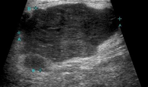 Phyllode Tumor