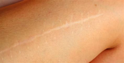 What Causes White Scars Or Hypopigmentation Evitalab™