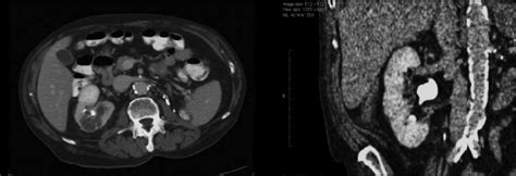 Post Treatment Axial Contrasted Abdominal Ct Scan Demonstrating