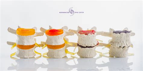 Flatback Syndrome Treatment Plano Tx Advanced Spine Center