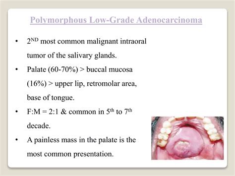 Salivary Gland Tumors Pptx