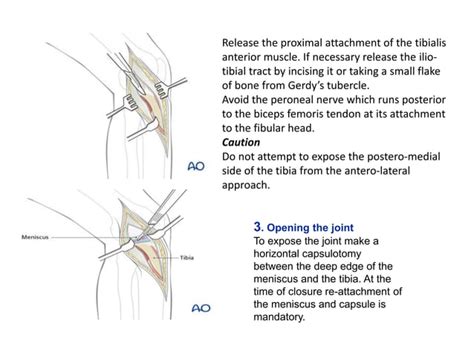 Proximal Tibia Approach Pptx