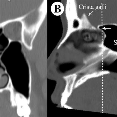 Keros Classification According To Gender Among Different Studies N Download Scientific Diagram