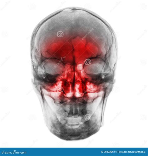 Sinus Mri Stock Image 43246363