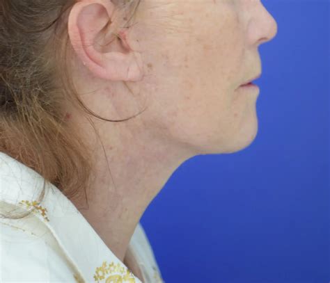 Lifting De Cuello O Lifting Cervical Ritidectomia Antiaging Group
