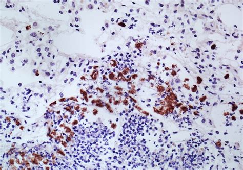 V13 N3 5 Disseminated Acanthamoebiasis In A Horse Bjvp
