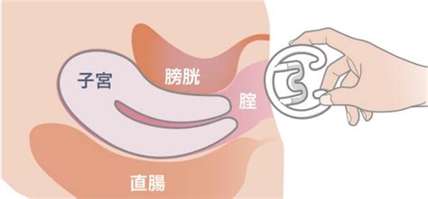 ペッサリーの使い方 骨盤臓器脱治療用リング 北里リングペッサリー製品サイト