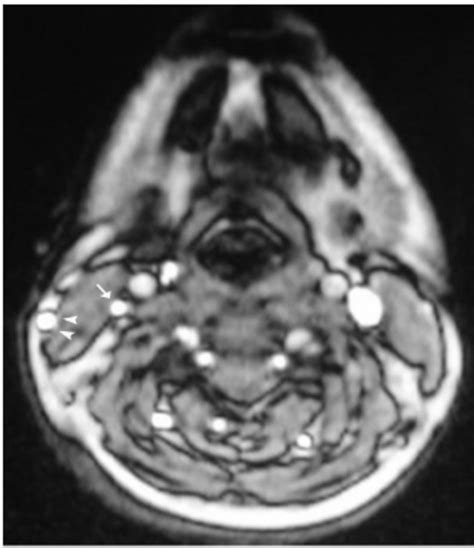 Axial 2d Tof Mri Neck Showing Loss Of Flow Related Enhancement Of Right