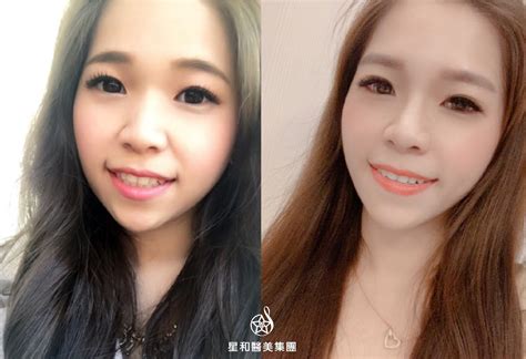 【玻尿酸】仁愛星和診所東區醫美 洪曼珊醫師 待嫁新娘的美麗心願，補出減齡好氣色下 Emily 萬人好評