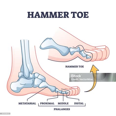 Hammer Toe Medical Problem As Foot Phalanges Deformation Outline