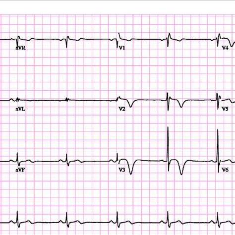 ECG Of Patient Shows T Wave Inversions Download Scientific Diagram