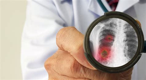 Pneumonia Sintomas Tipos E Como é O Tratamento Alta