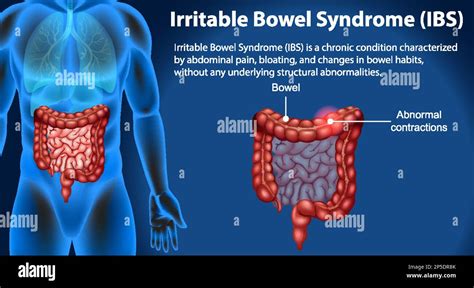 Irritable Bowel Syndrome Stock Illustrations And Cartoons