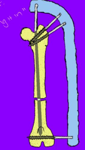 15 External Skeletal Fixation Flashcards Quizlet