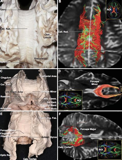 Corpus Callosum Neuroanatomy The Neurosurgical Atlas