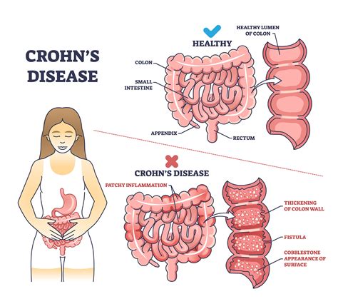 The Prevalence Incidence Of One Of The Most Dreaded Complications Of