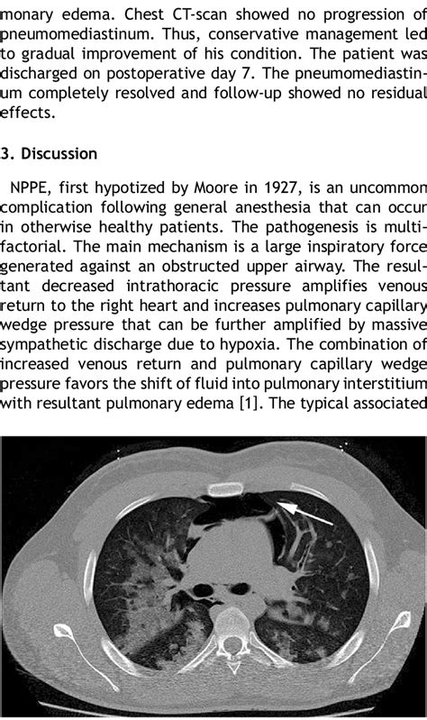 Chest Ct Scan Shows Bilateral Diffuse Pulmonary Infiltrates And The