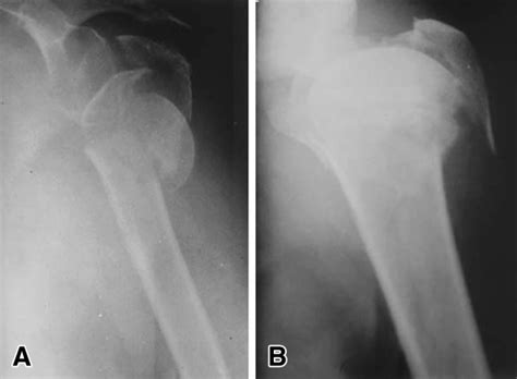 Classifications In Brief The Neer Classification For Proximal Humerus