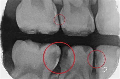 caries interproximal qué es causas y cómo tratarla de forma efectiva