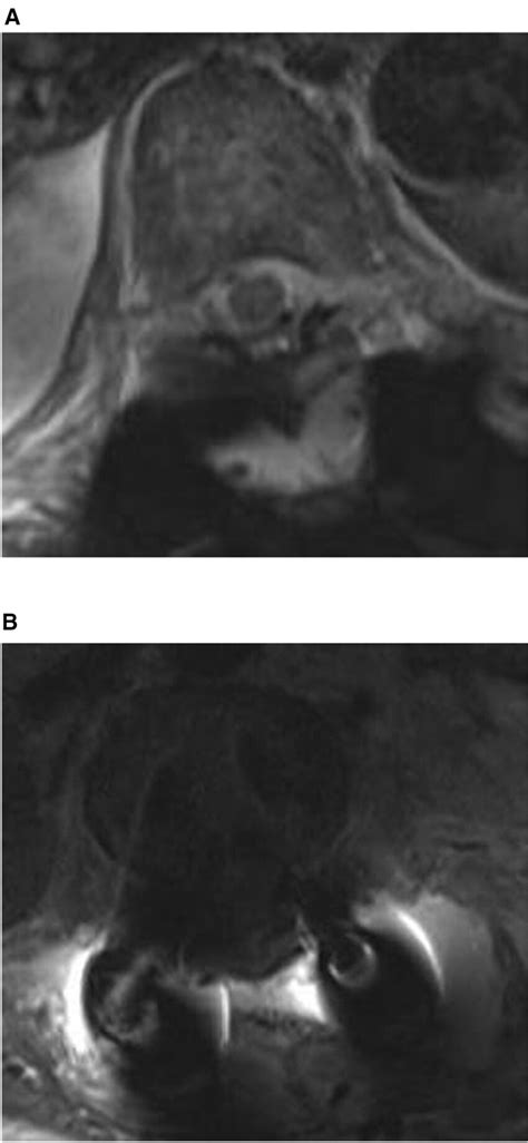 Preoperative T2 Weighted Magnetic Resonance Imaging Of The Thoracic And