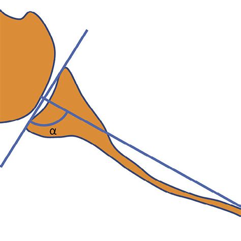 Glenoid Version α Measured In Axial Computed Tomography Plane In A