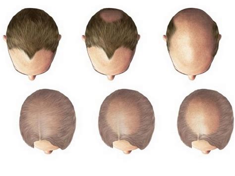 Diffuse Hair Loss Dr Niketa Sonavane