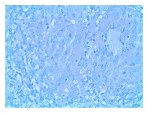 File Mycobacterium Tuberculosis Ziehl Neelsen Wikipedia 49 Off