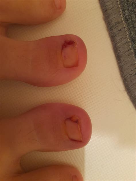Permanent Toenail Removal Ringrowntoenails