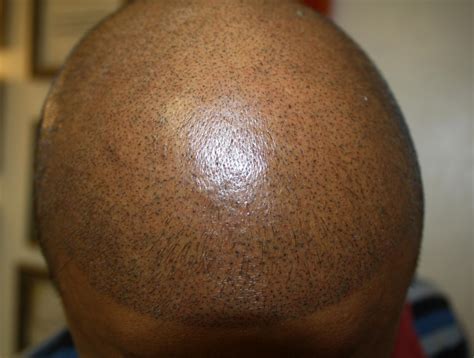 Scalp Pigmentation Saint Petersburg Florida Micropigmentation