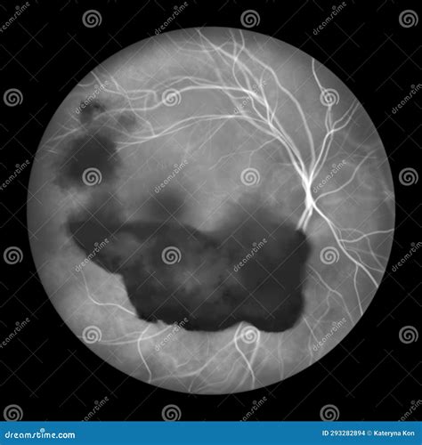 Vitreous Hemorrhage As Observed During Ophthalmoscopy Illustration