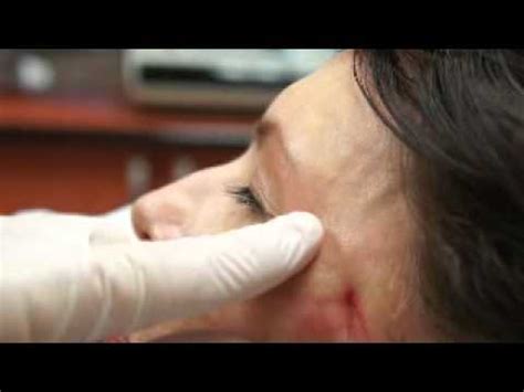 Radiesse Temples Videowmv Youtube