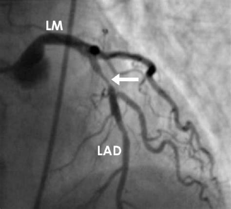 Cath Cases Angiogram Views Structures And Troubleshooting Dr M