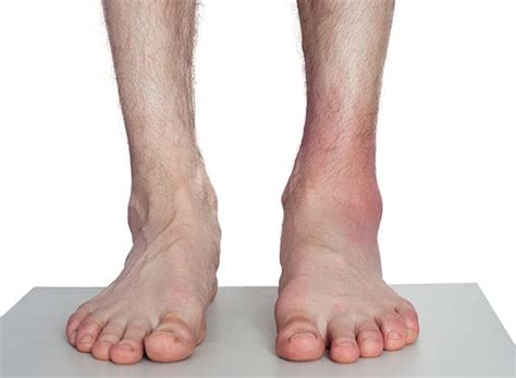 Sprains L A Foot And Ankle Center