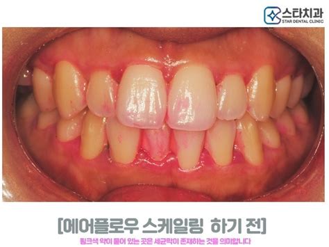 창원 마산 합성동 스케일링 창원 스타치과