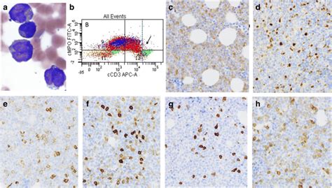 Patient 1 A Leukemic Promyelocytes In The Bone Marrow Wright Giemsa