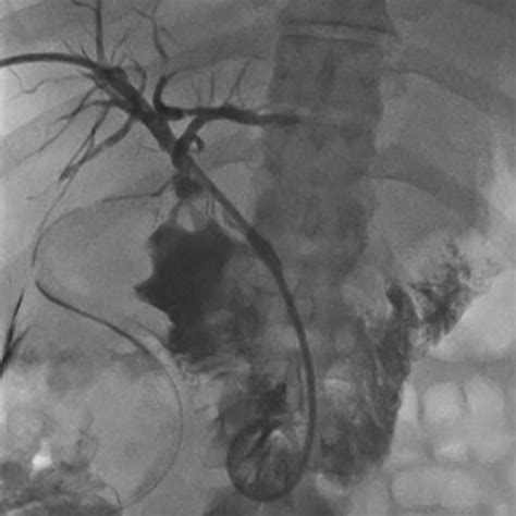 Cholangiographic Control After Placement Of Internal External Biliary Download Scientific