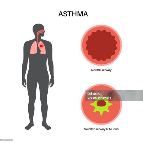 Asthma Lung Disease Stock Illustration Download Image Now Adult