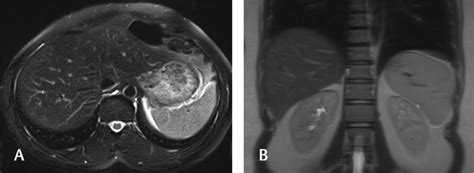 Axial Fat Suppressed T2 Weighted Image A And Coronal T2 Weighted Half