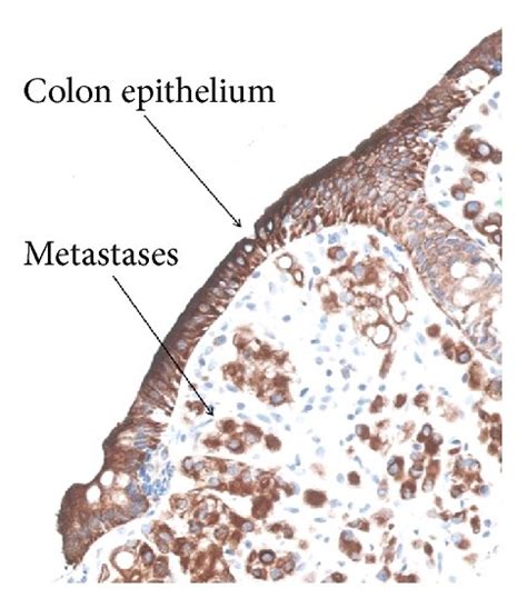 Histopathological Examinations Of Colon Biopsies Reveal Metastases Of