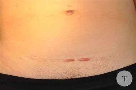 Keloid Scar C Section