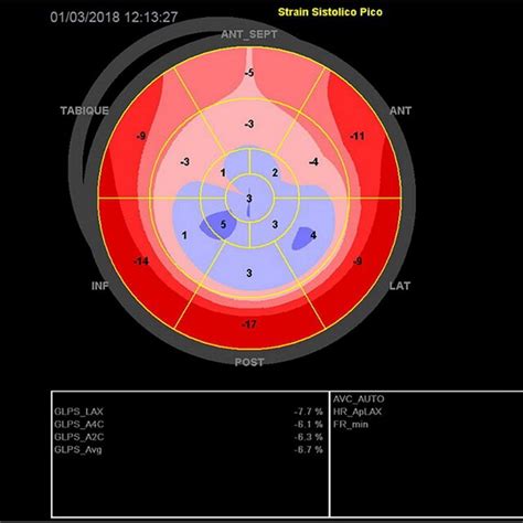 Global Longitudinal Strain Bulls Eye Plot At Day 22 There Is A
