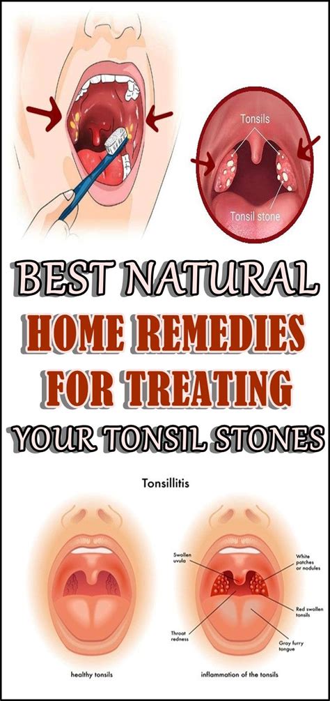 Tonsillitis