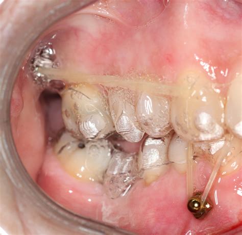 ¿para Qué Sirven Los Elásticos En Ortodoncia Ortodoncia Lozano