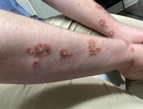 Dermdx Crusty Lesions On Forearms Clinical Advisor