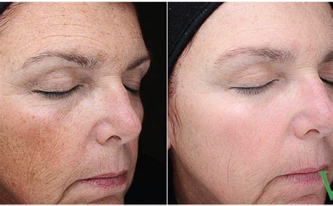 Plasma Fibroblast Service Brow Innovation