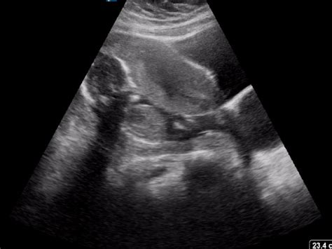 Miscarriage Critical Care Sonography