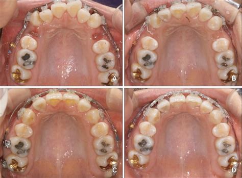 Occlusal Views Showing Relief Of Crowding And Retraction Of The