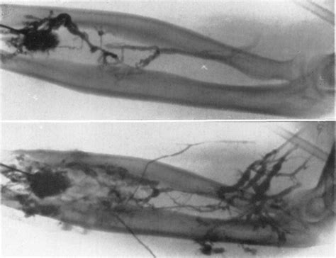 Figure 1 From Angiography In Soft Tissue Hemangiomas Semantic Scholar