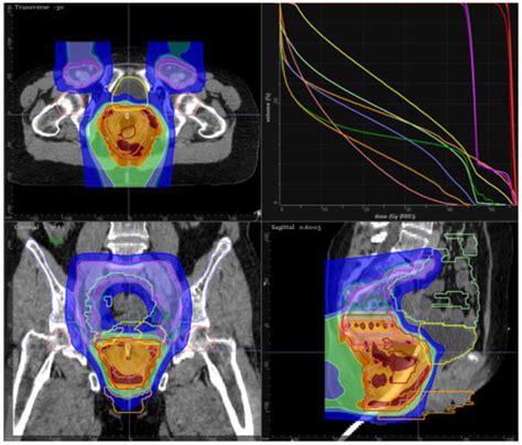 Example Of Pencil Beam Scanning Proton Plan For Patient With Early Download Scientific Diagram